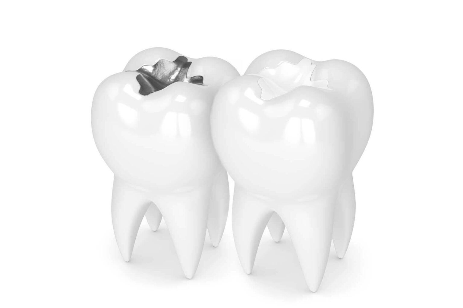 Tooth-Colored Fillings: Find the Best Shade for You